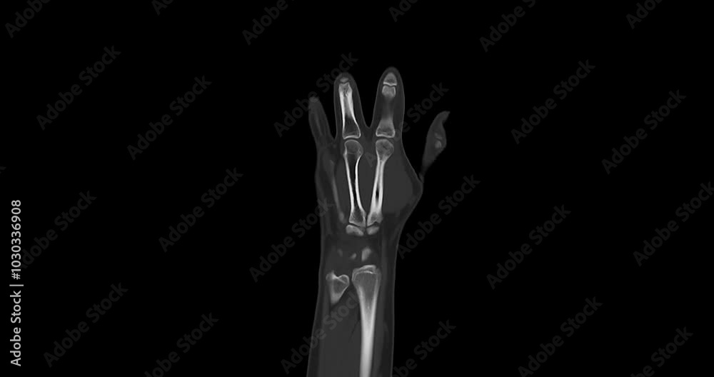 CT scan footage showing a detailed 3D rendering of a normal human hand ...