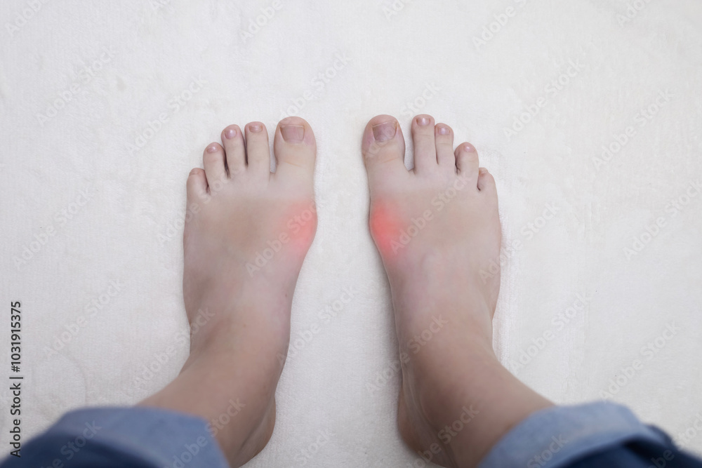 Hallux valgus, deformation of the big toe. Orthopedic doctor examines ...