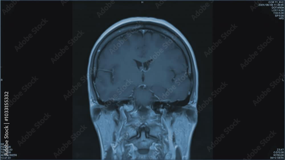 Magnetic resonance images of the brain, MRI of the brain, of a patient ...