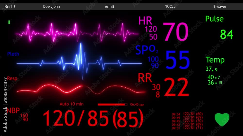 ICU medical monitor, irregular heartbeat. EKG monitor in ICU unit show ...