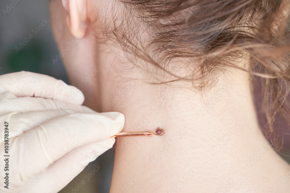 Woman examing her abnormal mole. Dermatology procedure. Doctor checking ...
