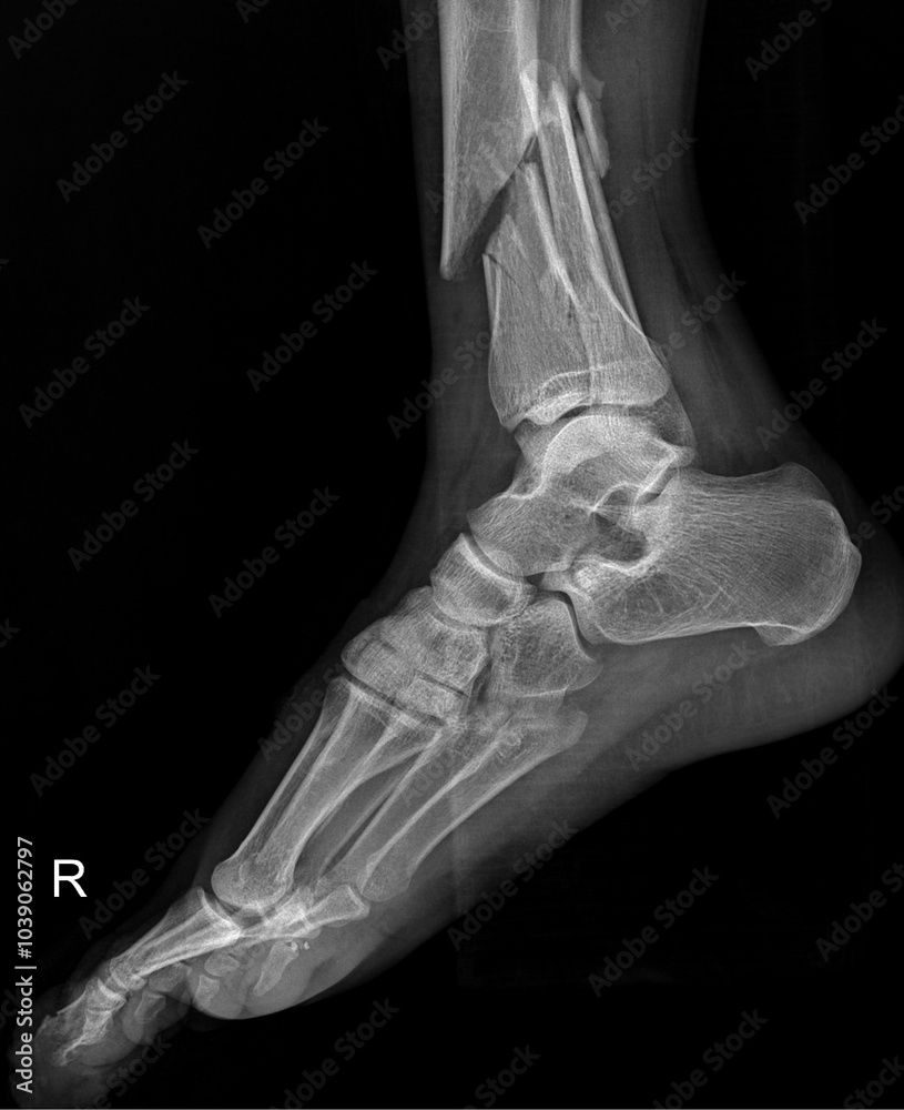 Photo & Art Print Foot lateral radiograph showing distal tibia fibula ...