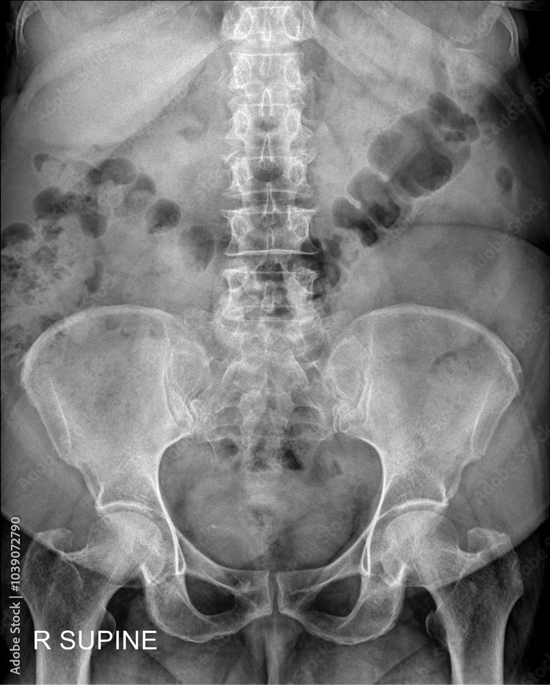 KUB X-ray for Comprehensive Imaging of Kidneys, Ureters, and Bladder Stock Photo | Adobe Stock