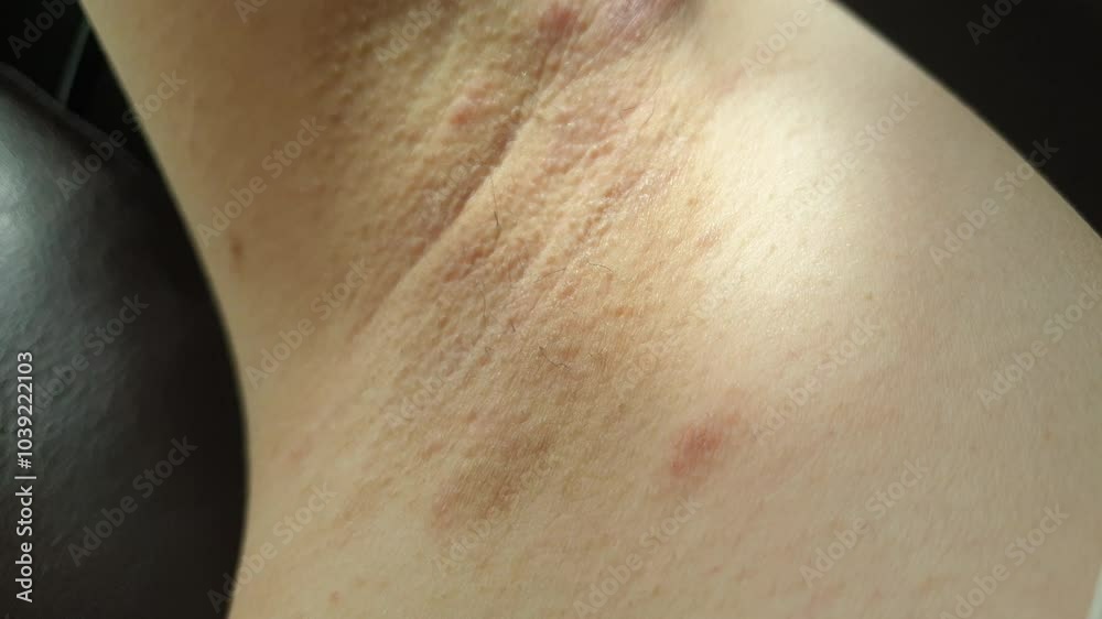 ringworm eczema infected on human body red rash ring on skin close up ...