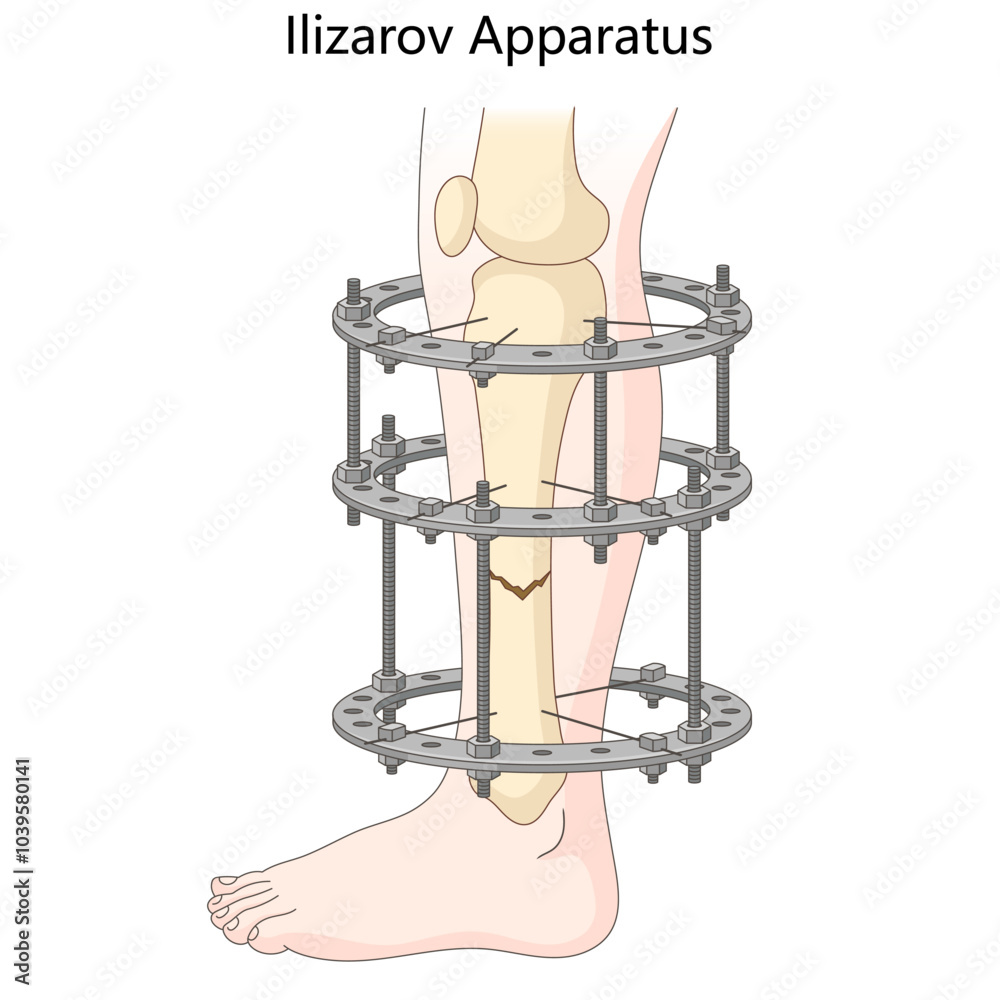 Ilizarov apparatus used for orthopedic limb lengthening and bone ...