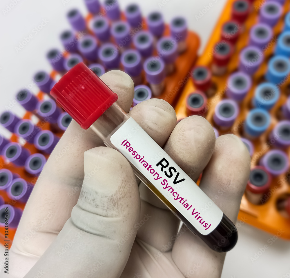 Foto de Blood sample for RSV (respiratory syncytial virus) test, Rapid ...