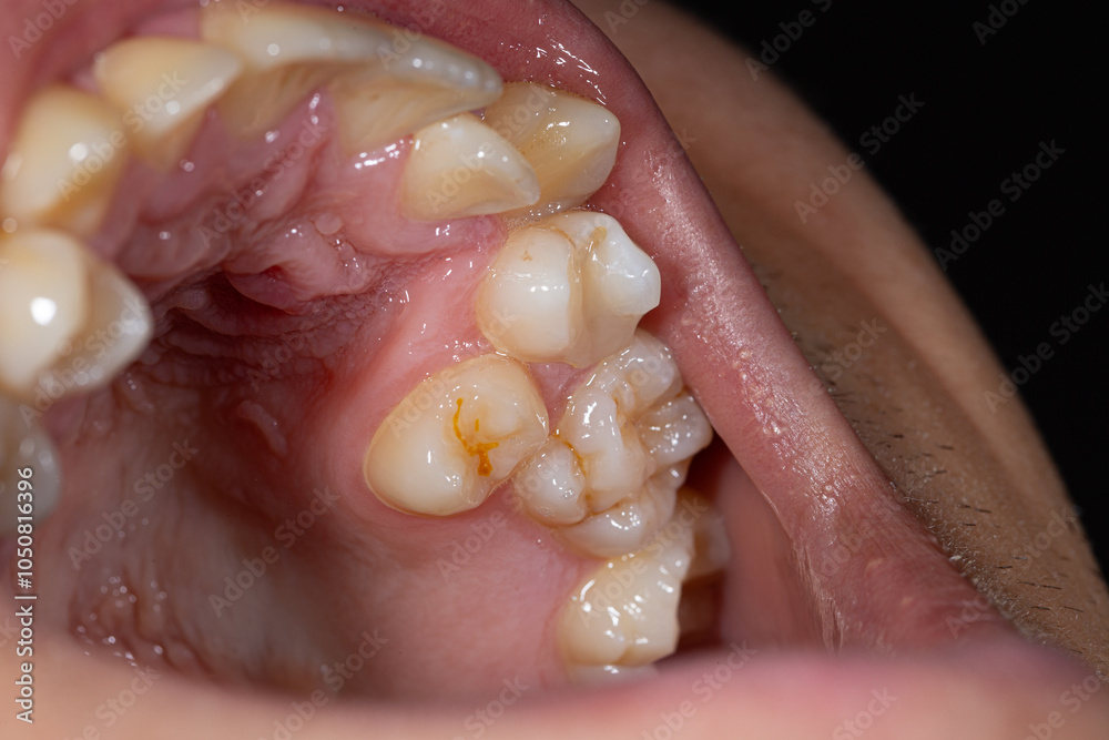 Close-up view of misaligned teeth showing jaw malocclusion and ...