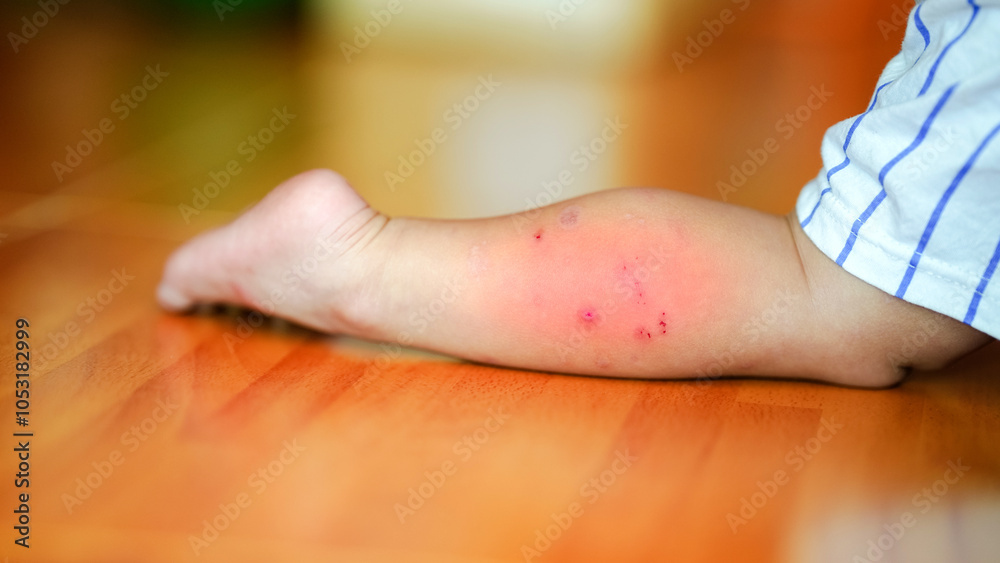 Close-up of a child's leg showing a red rash and multiple insect bites ...