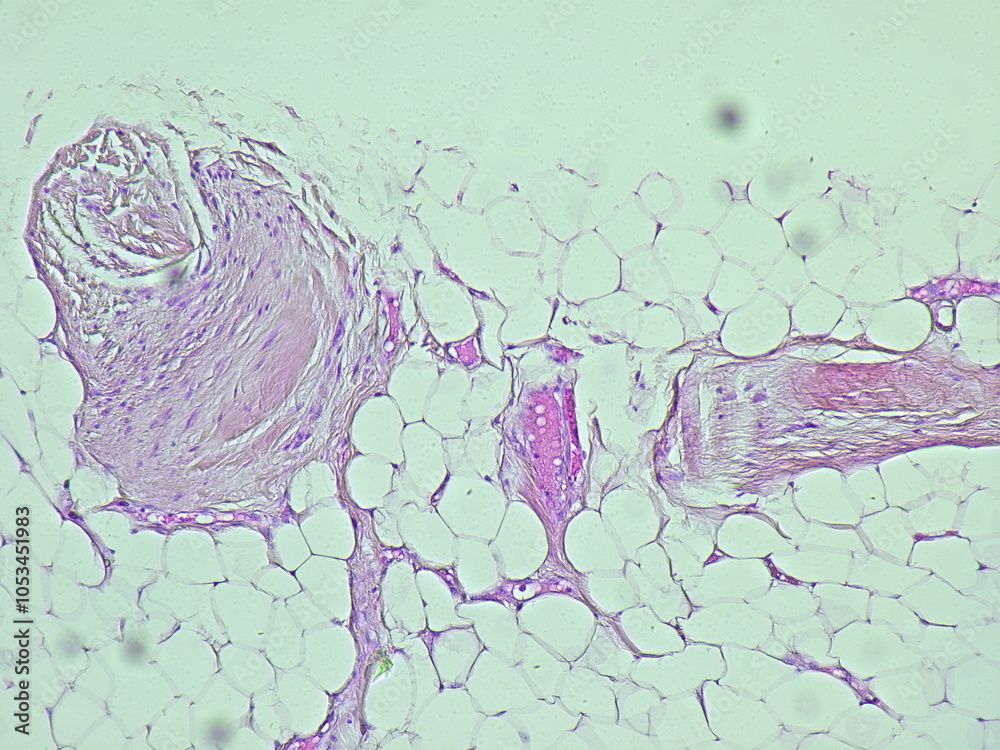 Photomicrograph showing histology of a Lipoma, benign growth of fatty ...
