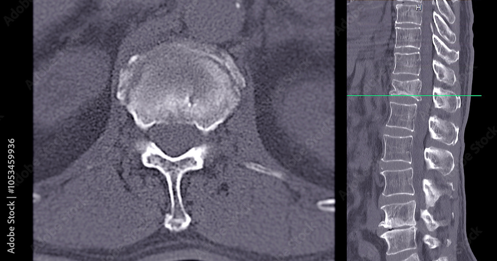 Spinal Compression Fracture at L1 Level - Lumbar CT Scan.A detailed CT ...
