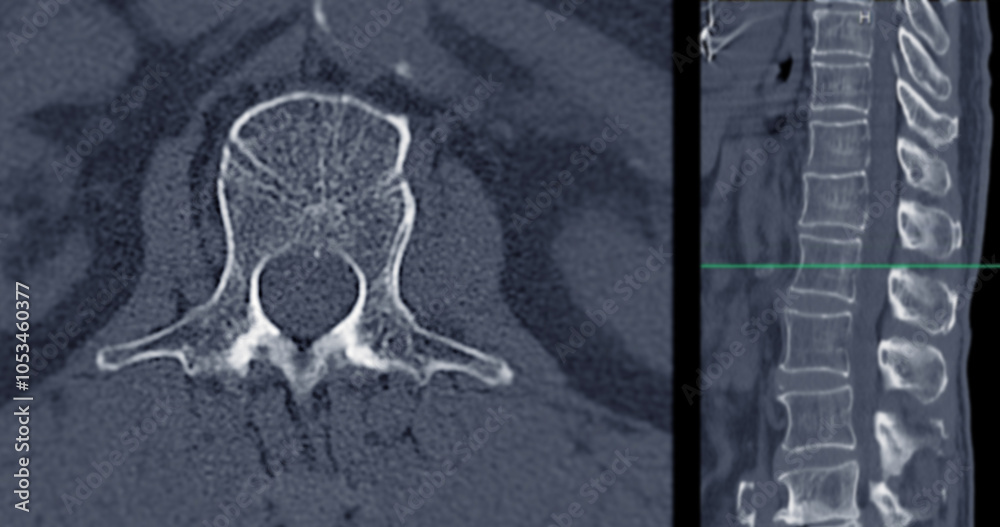Spinal Compression Fracture At L1 Level Lumbar Ct Scan A Detailed Ct