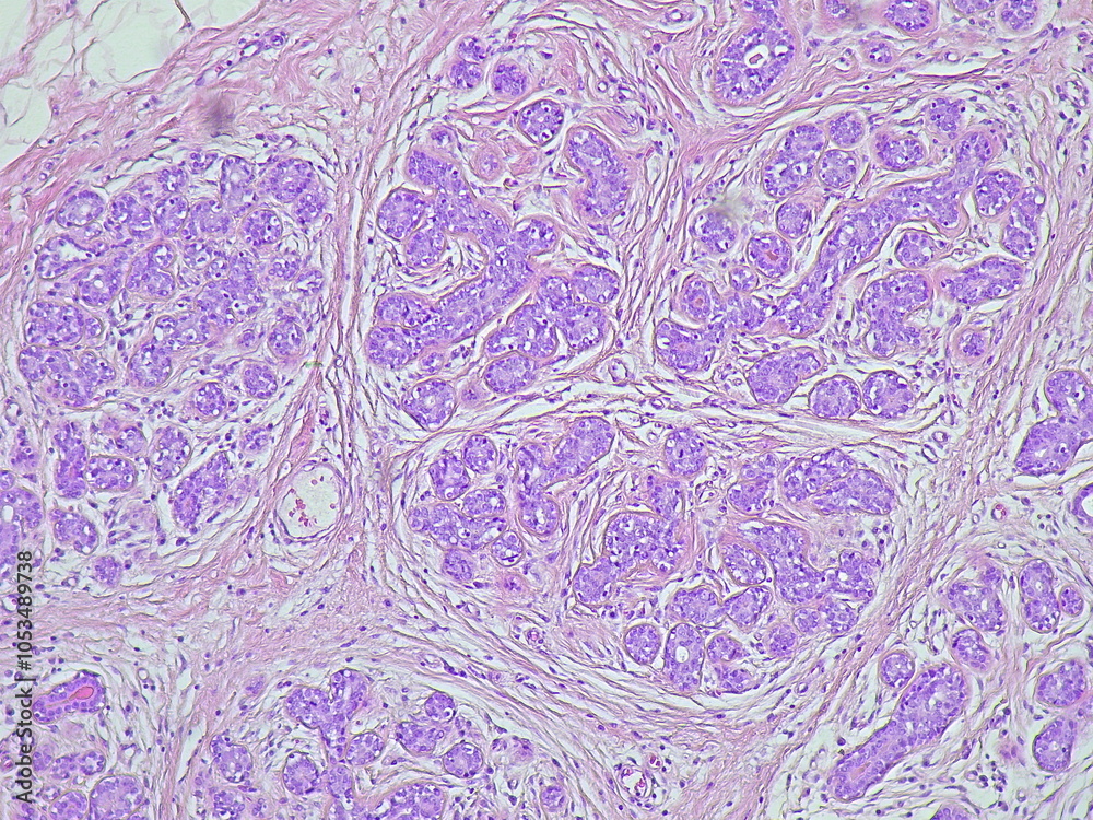 Human cervical cell tissue under a microscope in a pathology laboratory ...