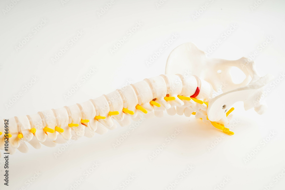 Fotografie, Obraz Spinal nerve and bone, Lumbar spine displaced ...