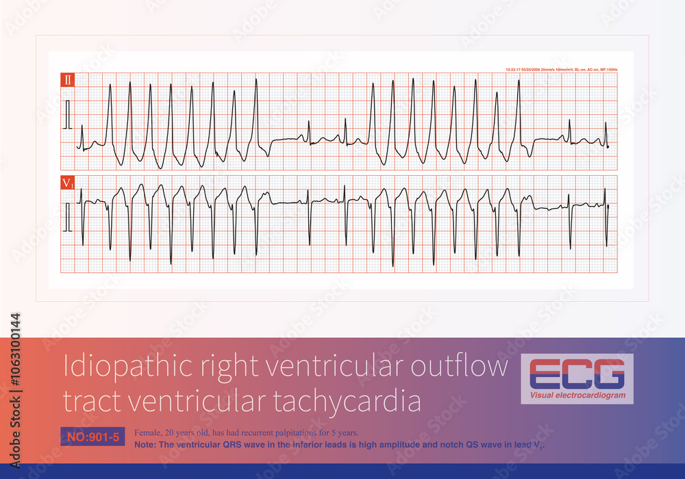 Poster Idiopathic ventricular tachycardia originating from the right ...