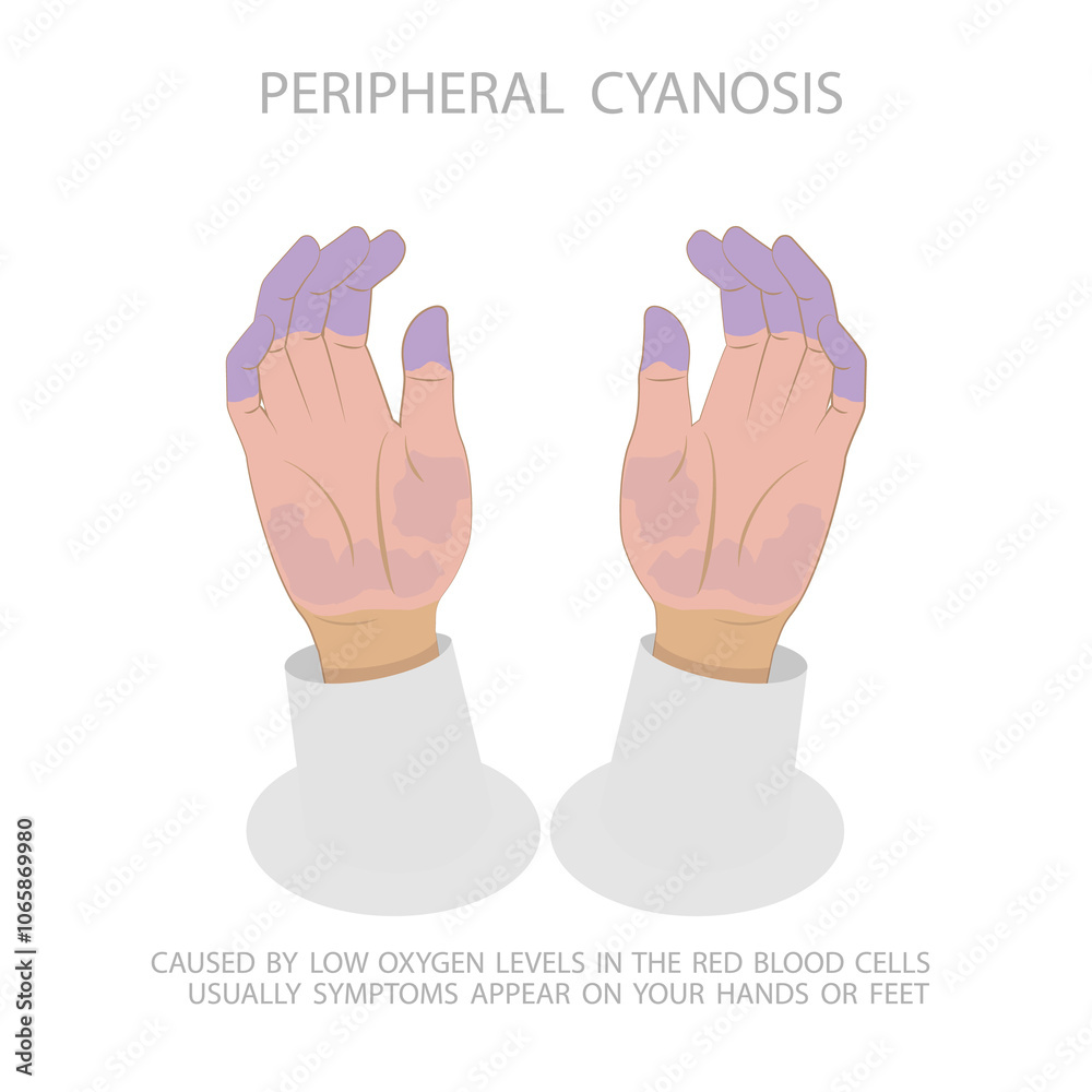 3D Isometric Flat Illustration of Peripheral Cyanosis Symptoms, Low ...
