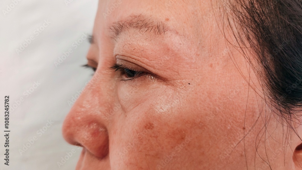 portrait freckles and blemish on the cheek, swelling and ptosis beside ...