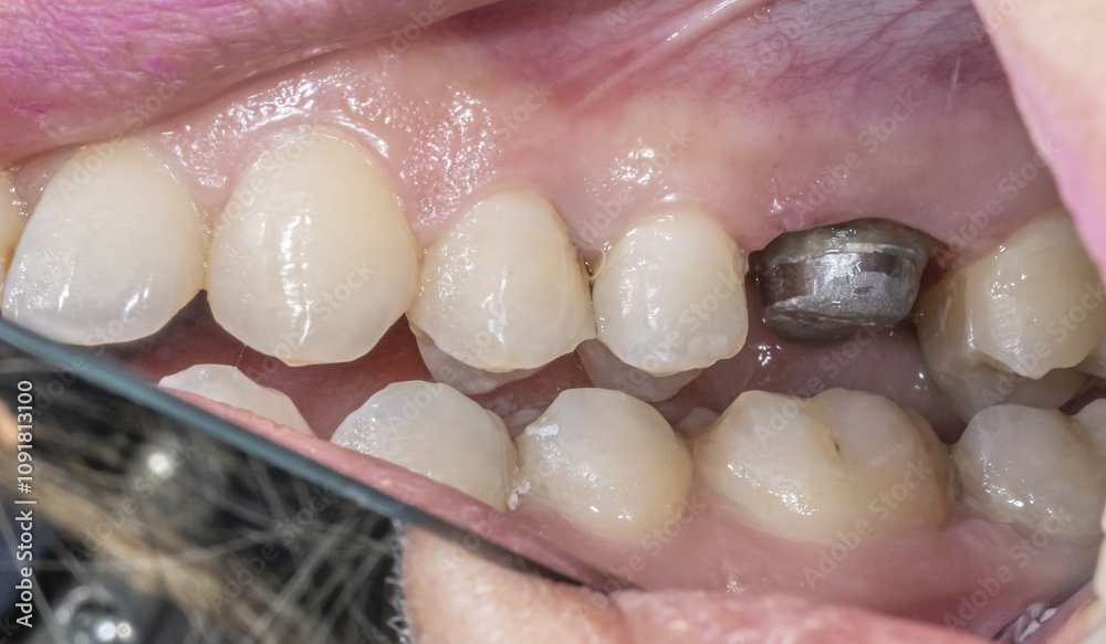 Lateral view of dental arches open occlusion showing a lower molar with ...