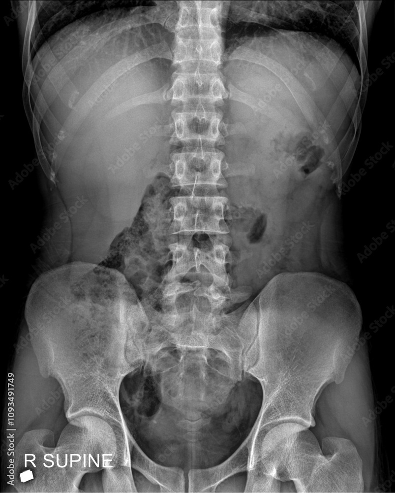 Kidney, Ureter, Bladder X-Ray for Diagnosing Kidney Stones Stock Photo ...