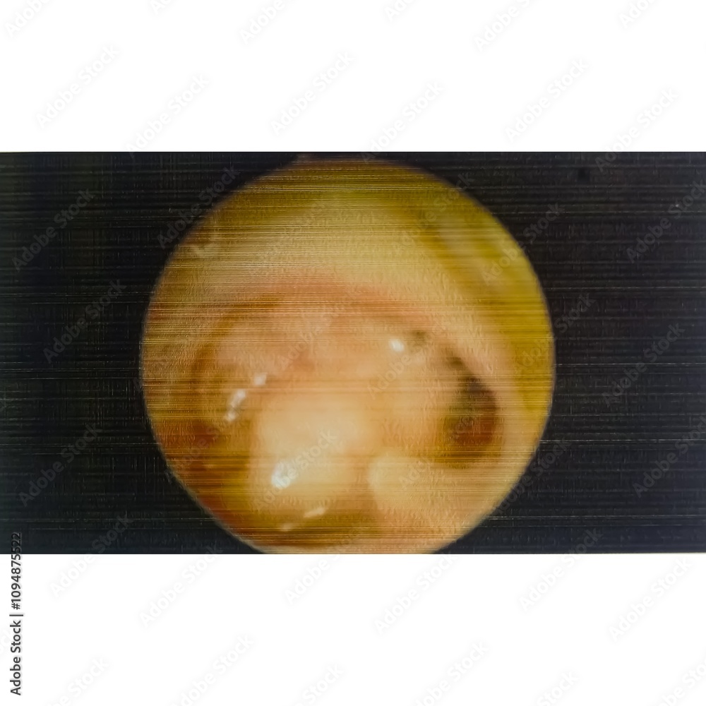 Ear endoscopy. Chronic suppurative otitis media (CSOM). Subtotal ...