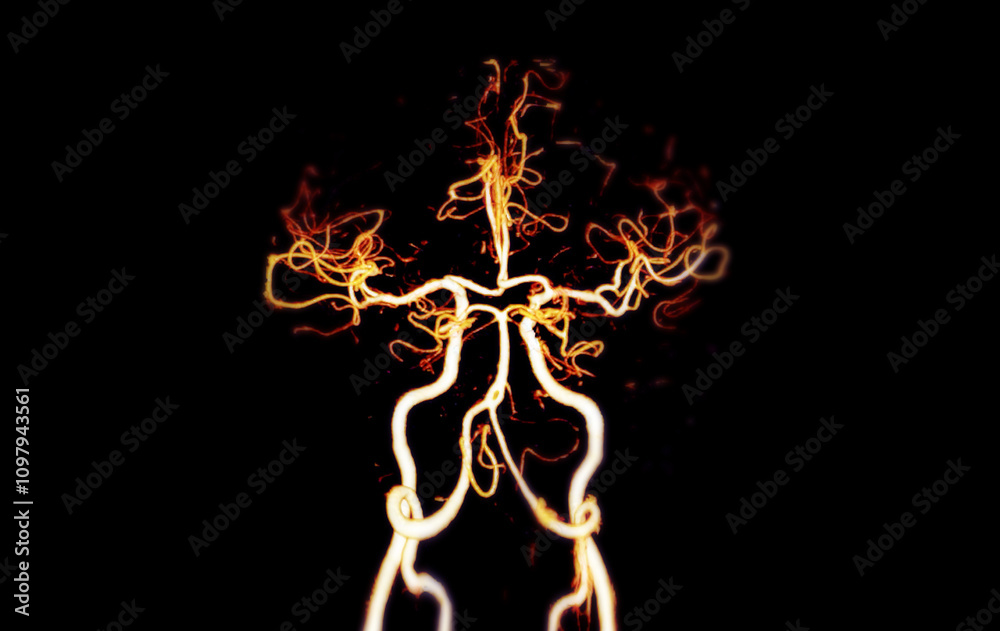 The CT Angiography (CTA) scan of the brain and neck, showcasing the ...