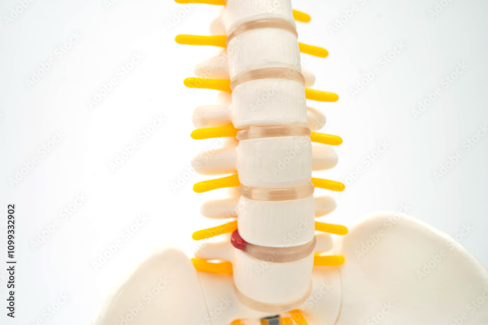 Spinal nerve and bone, Lumbar spine displaced herniated disc fragment ...