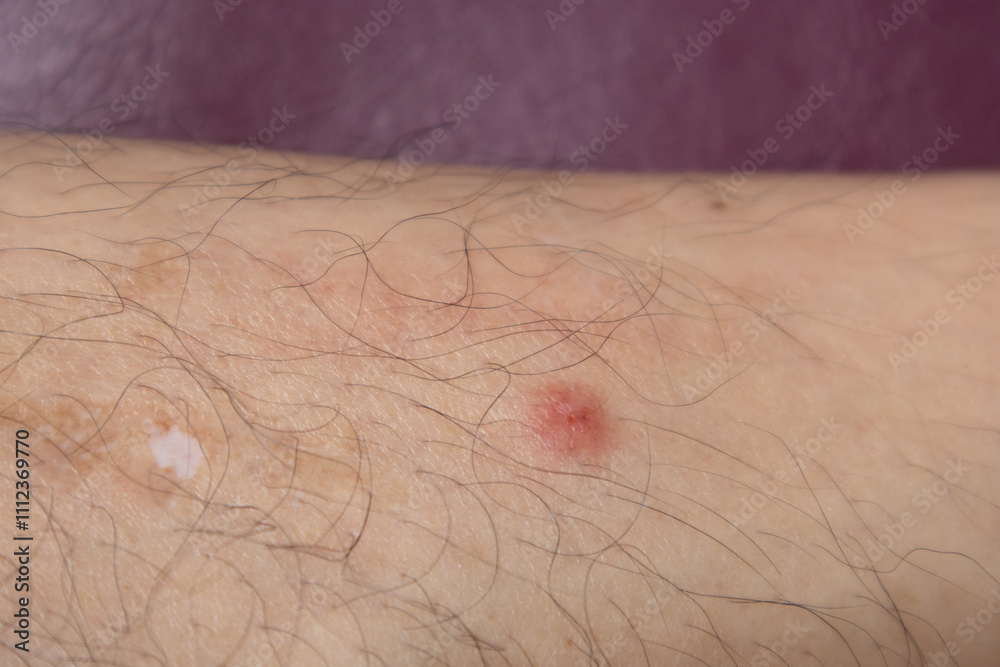 The blisters are red and itchy on the patient's skin that are caused by ...