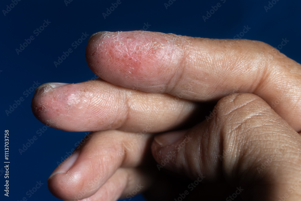 Photo & Art Print Fingers of a patient with atopic dermatitis after ...