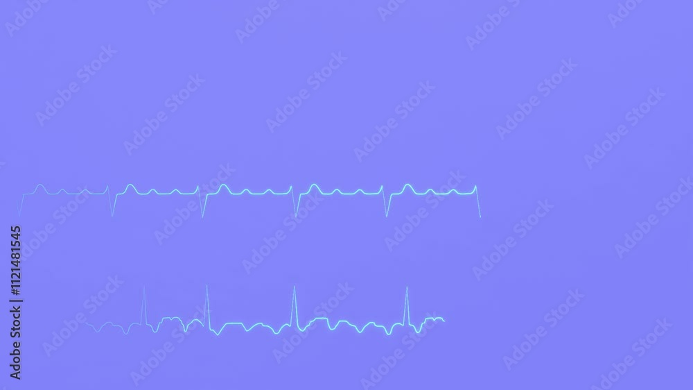 ECG graphs of regular and irregular atrial flutter Stock Video | Adobe ...