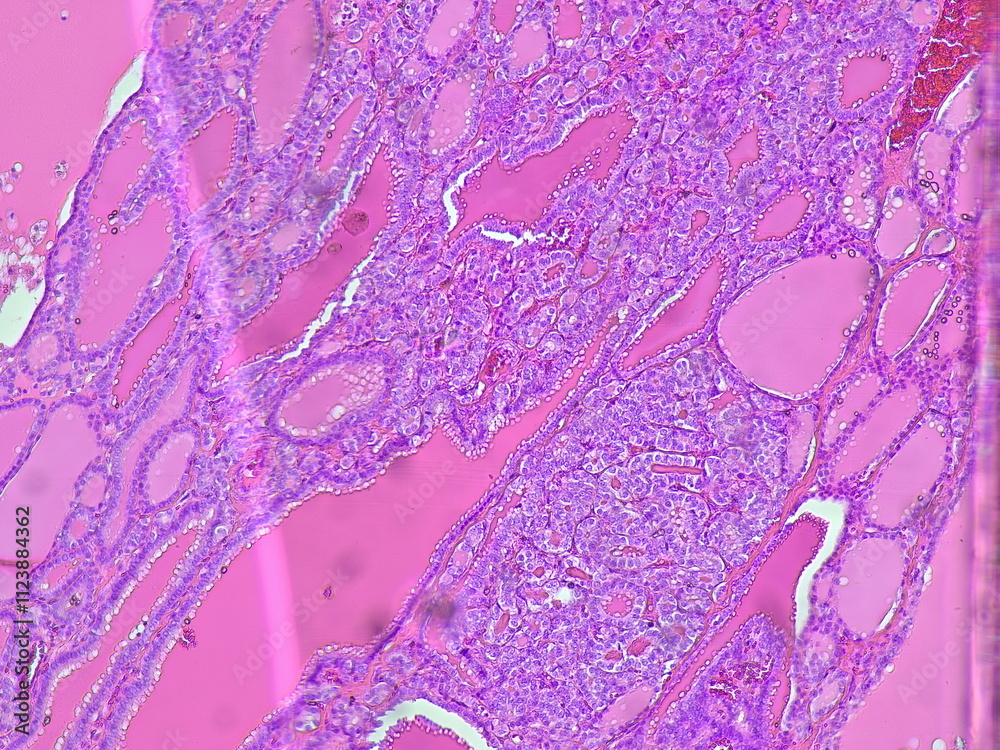 Póster Photomicrograph showing histology of benign thyroid nodule under ...