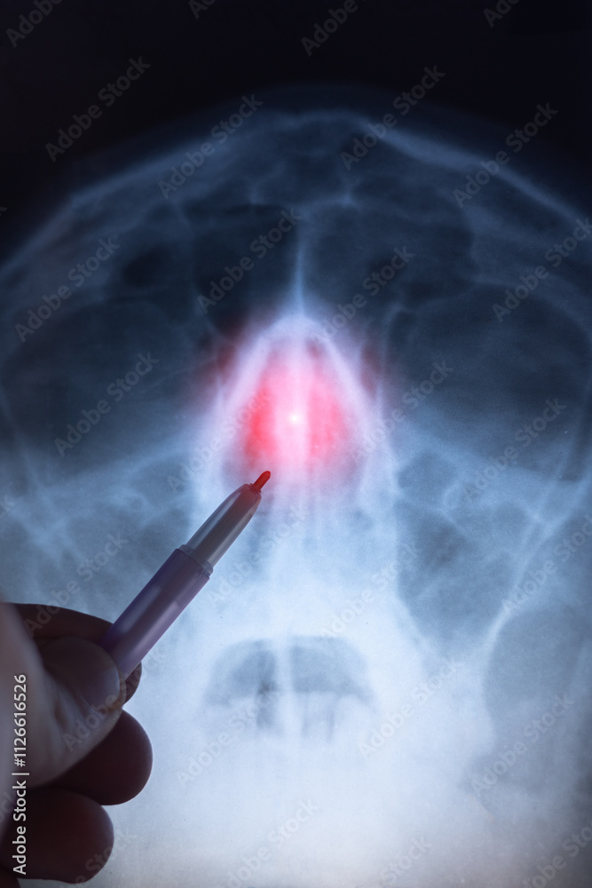 Doctor learning Vertical X-ray scan of a human skull. Deviated septum ...