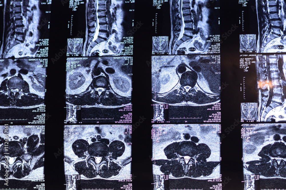 Magnetic resonance image of human spine. MRI of lumbar spine. Pinched ...