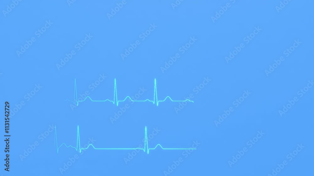 ECG graphs comparison of normal heart rhythm and arrhythmia vídeo de ...