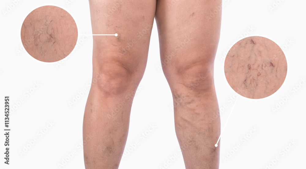 Removal of varicose veins on the legs. Medical inspection and treatment ...