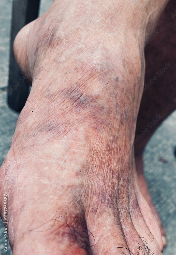 Varicose veins on feet caused by prolonged work hours. Image shows ...