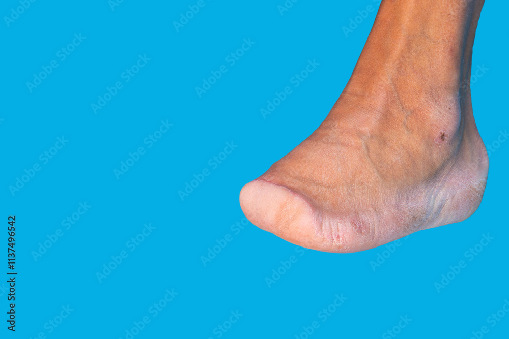 Amputation of all toes of a diabetic man's foot, diabetic foot, shampoo ...