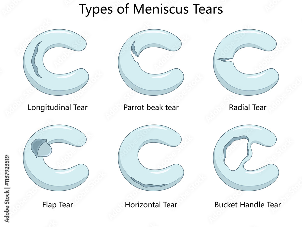 meniscus tears, including longitudinal, radial, parrot beak, flap ...