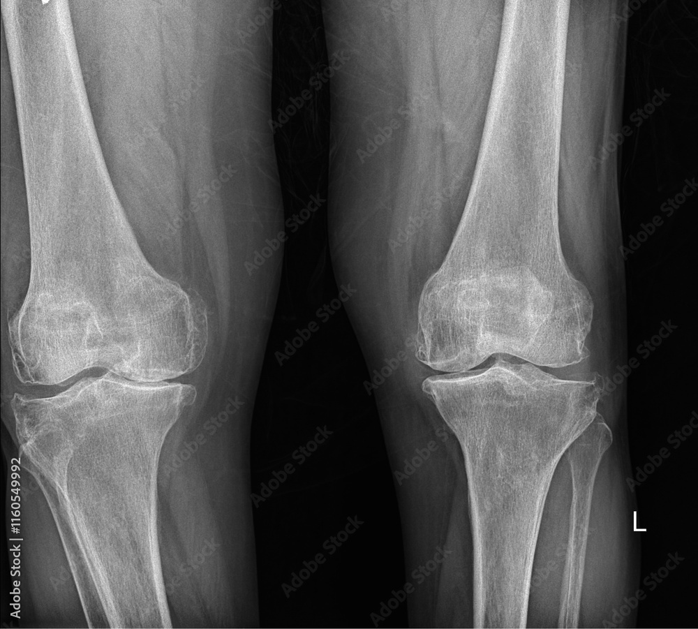Poster Knee Joint Imaging for Cartilage Wear Assessment – Wall Art ...