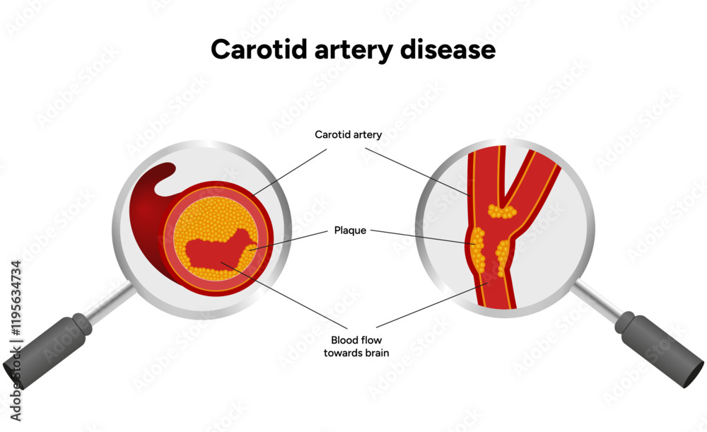 Poster Carotid artery disease Signs of Carotid Artery Disease medical ...