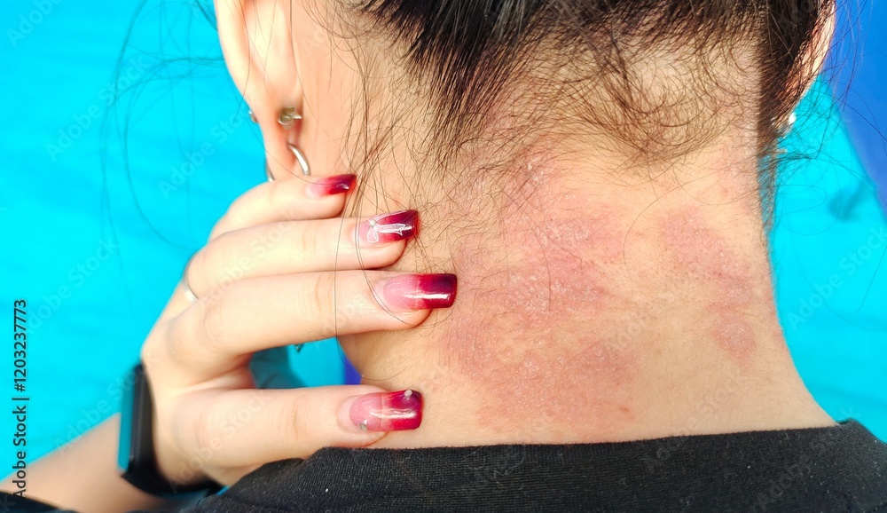 Fotografering, Billede portrait the rash hives allergy and inflammation ...