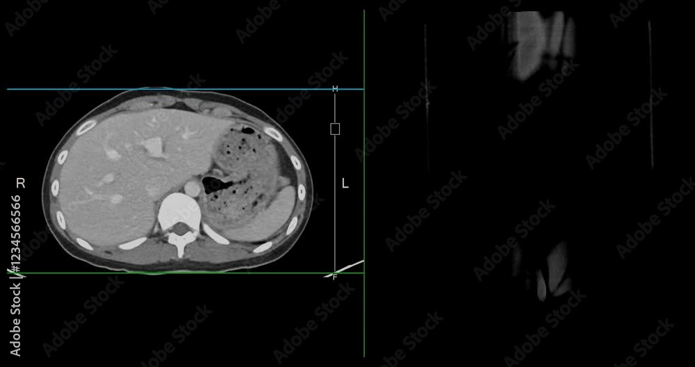 CT whole abdomen normal study: No abnormalities detected. All organs ...