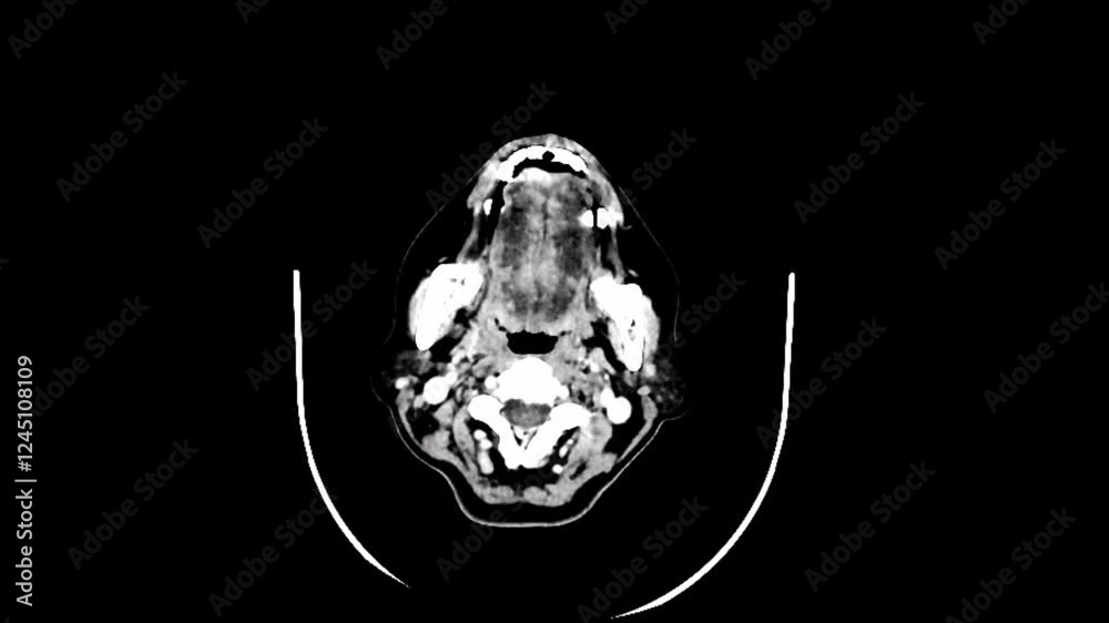 Axial computed tomography (CT) scan of the head showing an intra-axial ...