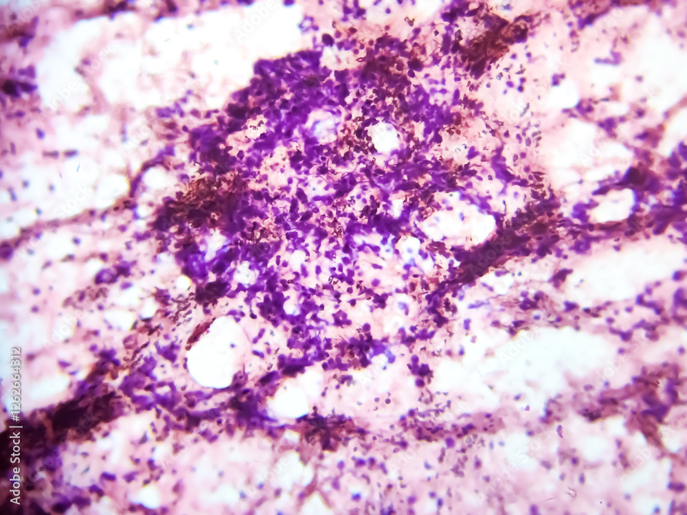 Poster Malignant cells, bronchoalveolar lavage (BAL) adenocarcinoma ...