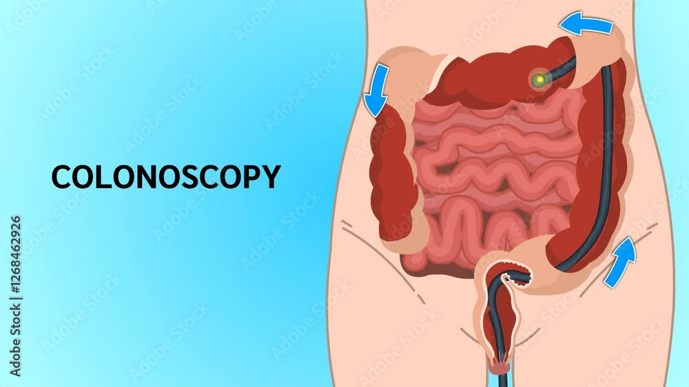 Colonoscopy is a medical procedure used to examine the inner lining of ...
