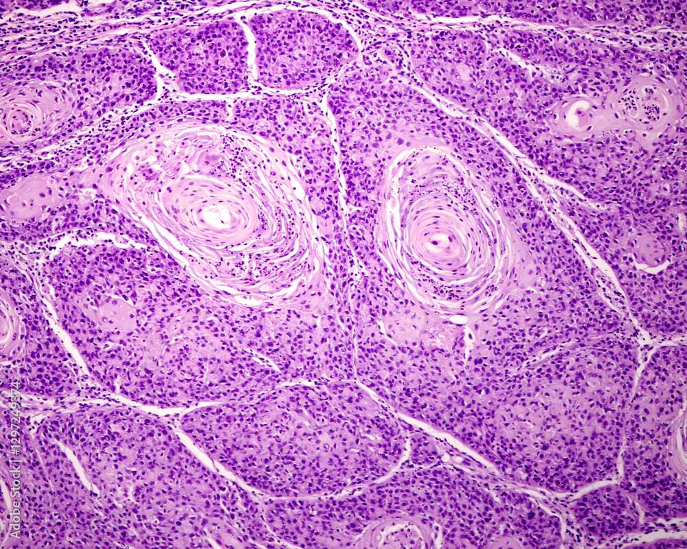 Poster Human skin. Squamous cell carcinoma – Wall Art | UkPosters