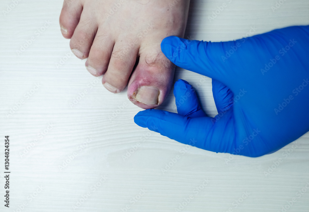 Poster Finger infection – Wall Art | UkPosters