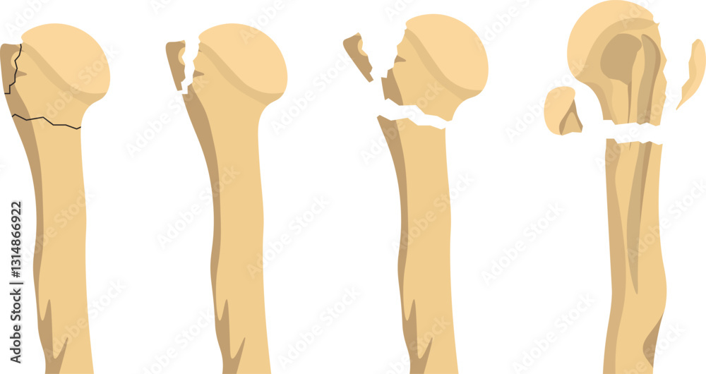Poster The Neer Classification categorized proximal humerus fractures ...