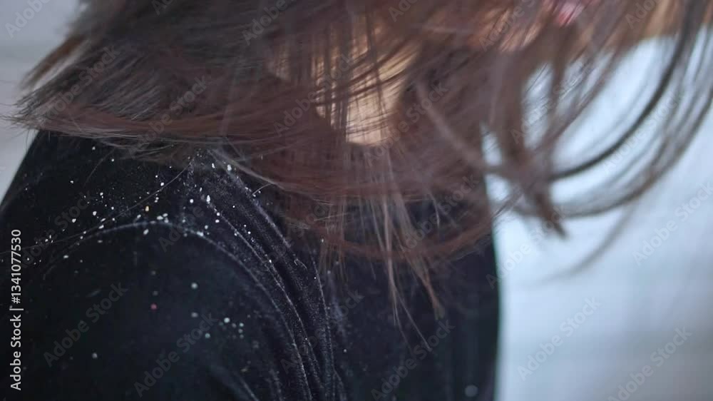 woman scratching itchy scalp, struggling with dandruff, white flakes on ...