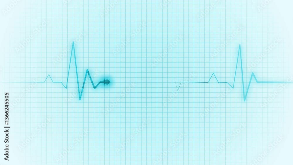 ECG Heartbeat Waveform on Grid Background Animation, Electrocardiogram ...