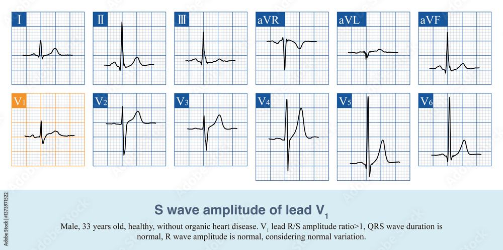 Poster When the ratio of R wave amplitude to S wave amplitude in lead ...