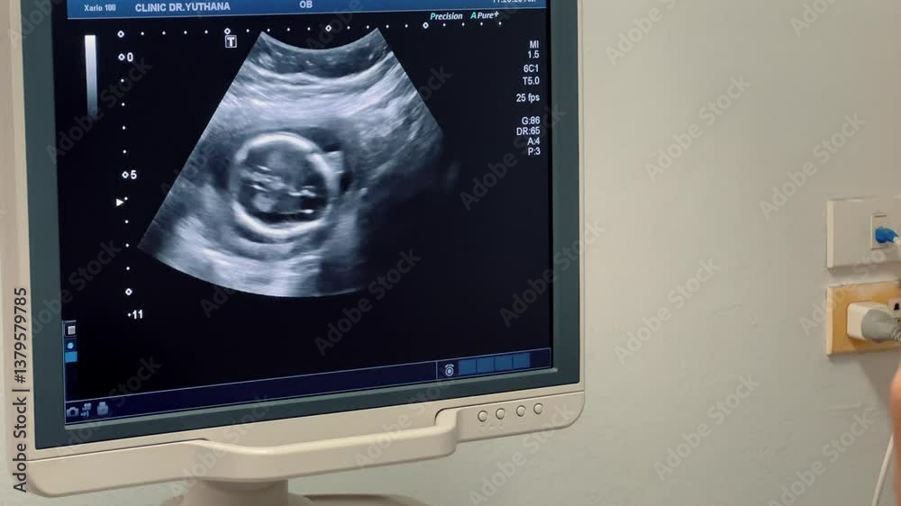 2D Ultrasound display of 18 weeks pregnant. Fetus ultrasound image that ...